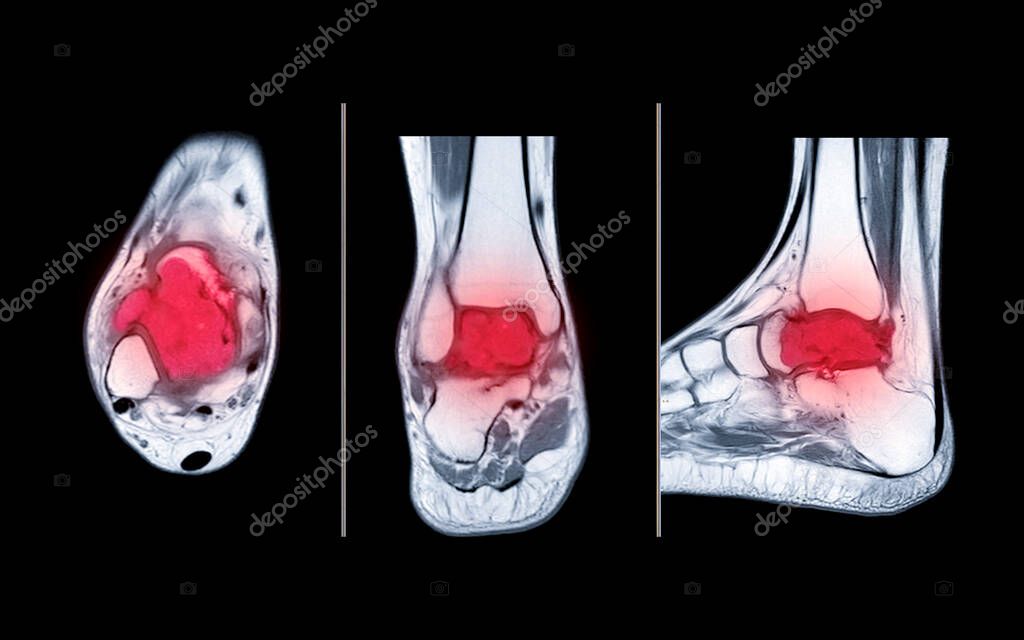 Comparación de la RM tobillo axial, coronal y sagital PDW vista mostrando metástasis óseas al ...