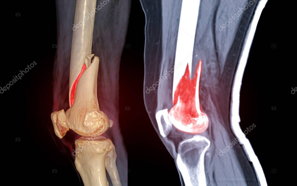 CT rótula representación 3D imagen vista lateral y vista Sagital ...