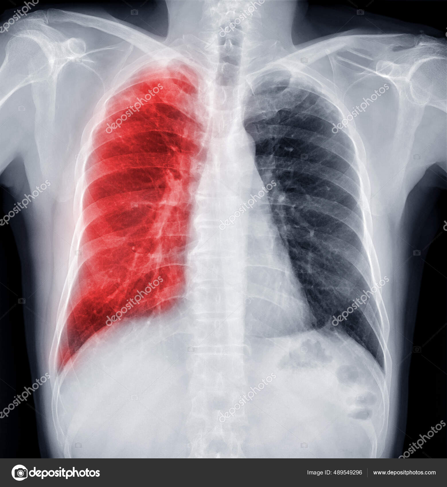 Radiografía Tórax Pecho Pulmón Humano Para Detectar Tuberculosis ...