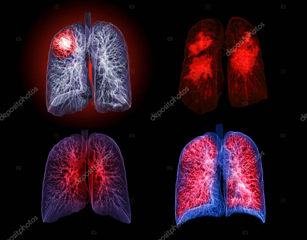 Recopilación de imágenes de la tomografía computarizada de tórax o ...