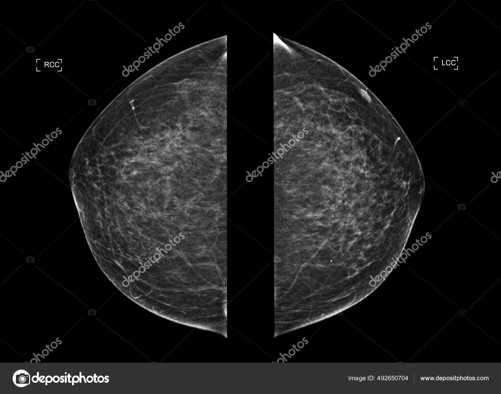 Breast Cancer Digital Mammogram