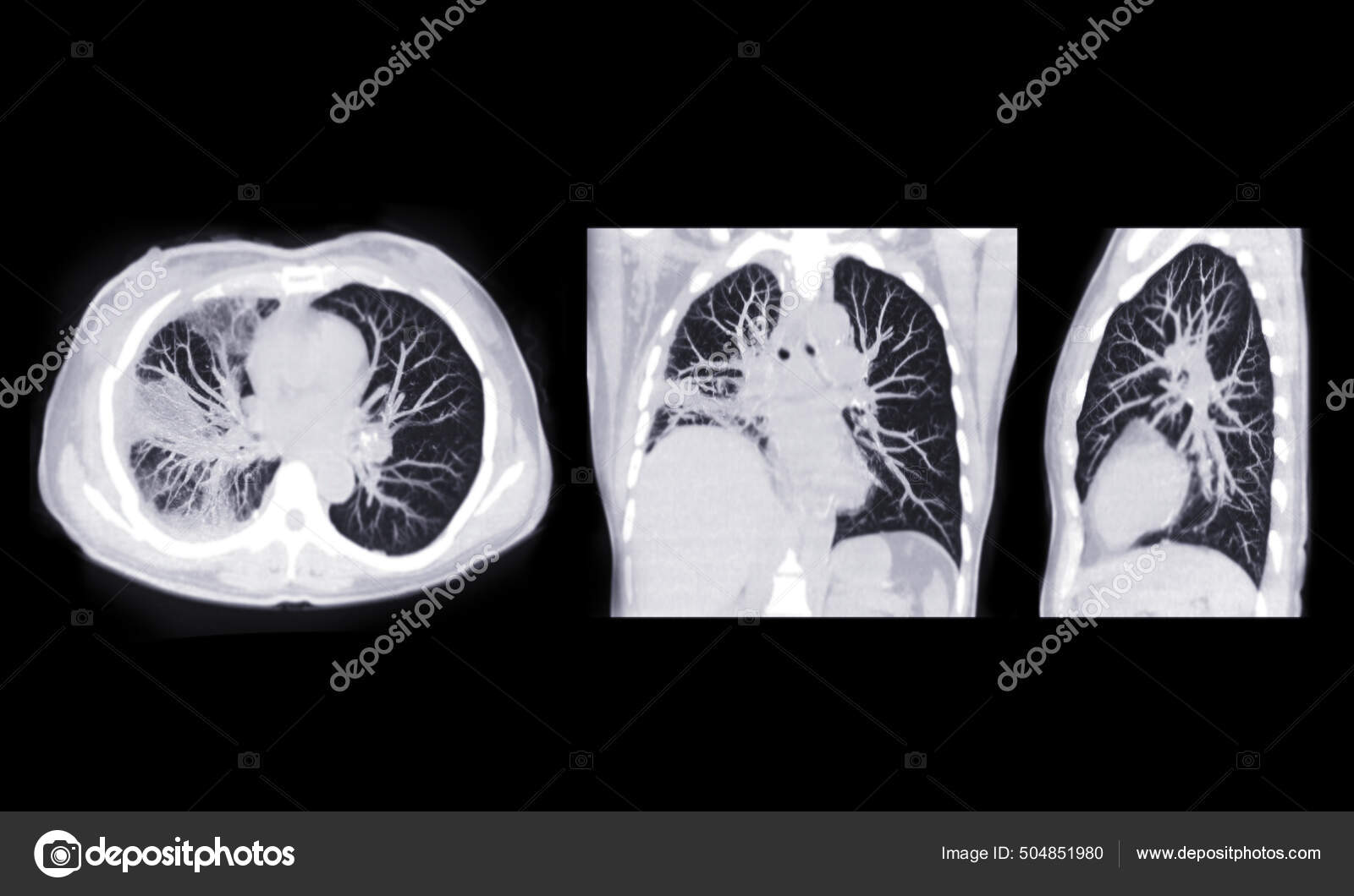Scan Chest Lung Axial Coronal Sagittal Mip View Lung Infection — Stock ...
