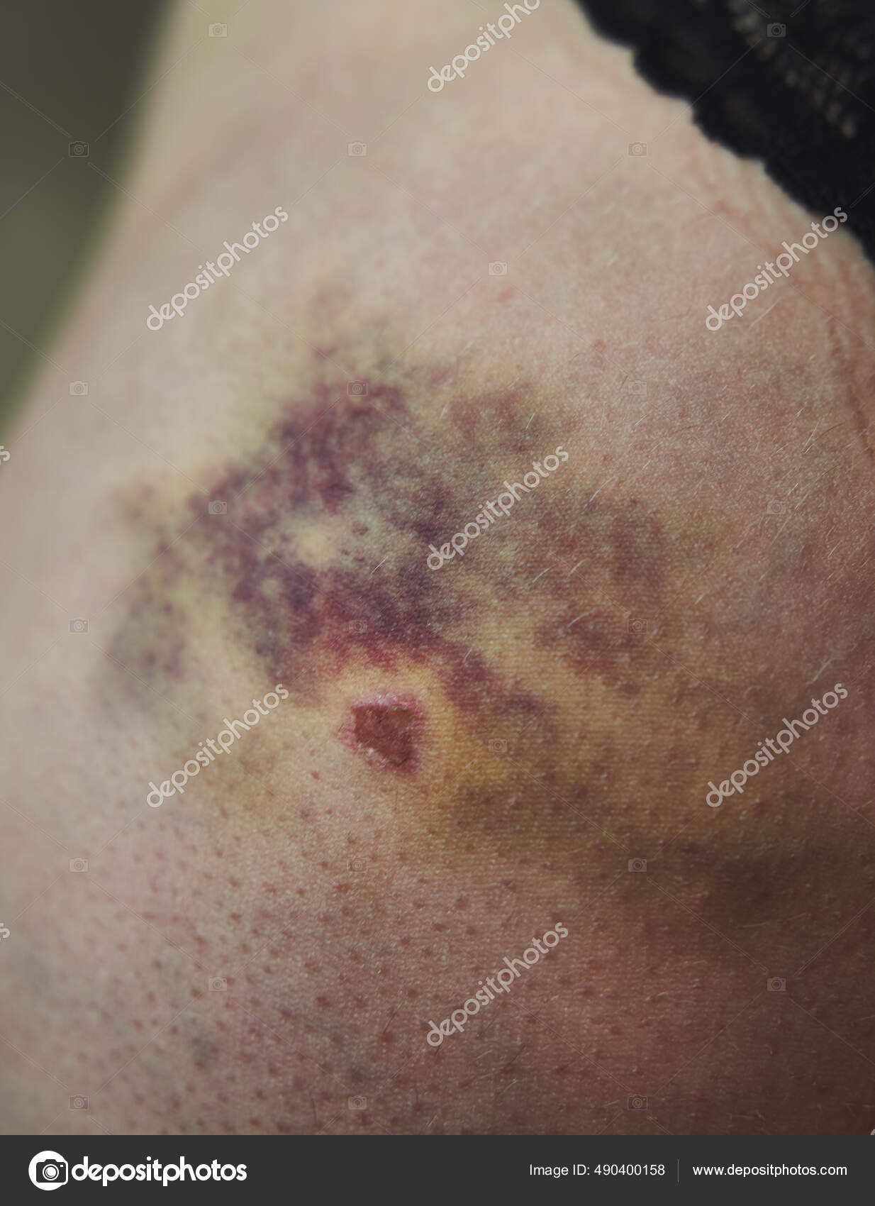 Trauma Skin Accident Haematoma Recovery Process Inner Bleeding Impact ...