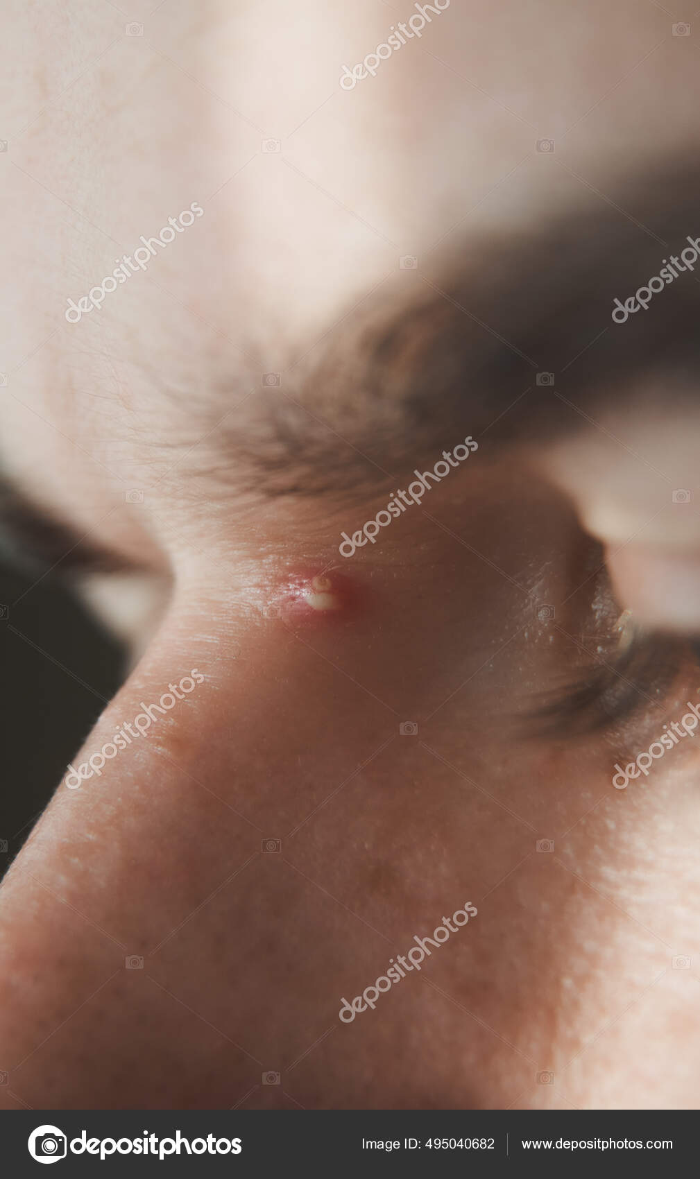 Macro Photos White Red Ripe Pimple Face Man Eye Nose — Stock Photo ...