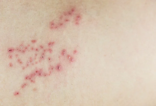 Itchy Pimple Rash On Back