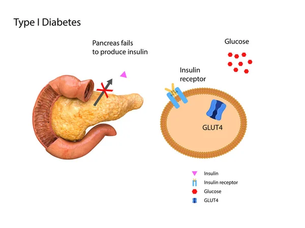 Diabetes types Stock Photos, Royalty Free Diabetes types Images ...