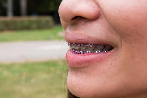 Teenage girl braces Stock Photos, Royalty Free Teenage girl braces ...