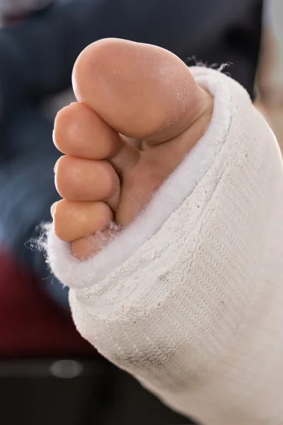 Fiberglass / Plaster leg cast - Stock Image - Everypixel