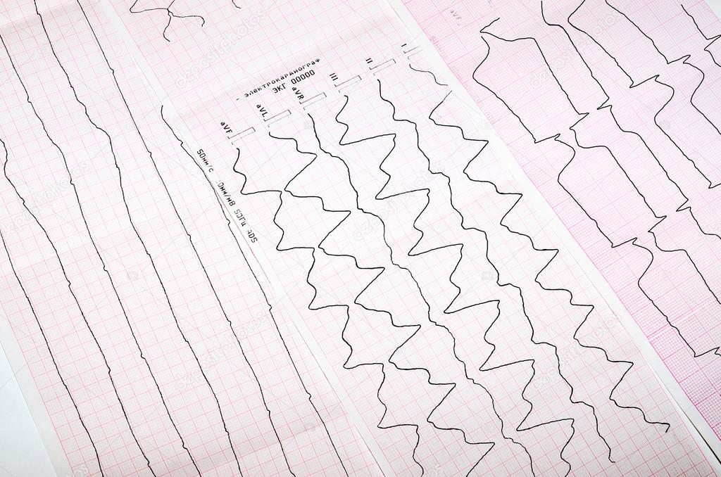 Three tape ECG with acute coronary pathology — Stock Photo © Olga355 ...