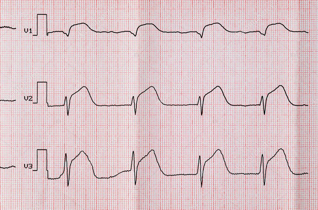 ECG con infarto agudo de miocardio anterior macrofocal 2023