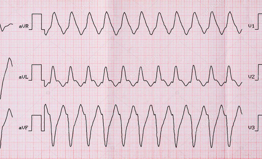 Atrial Flutter Life In The Fast Lane Ecg Library