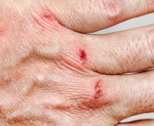 Skin abrasion Stock Photos, Royalty Free Skin abrasion Images ...