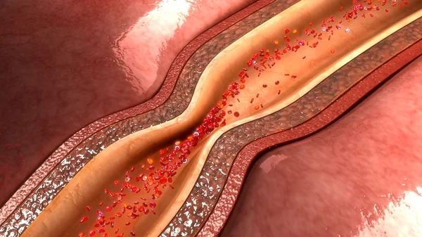 Coronary artery vessel — Stock Photo © sciencepics #112248968