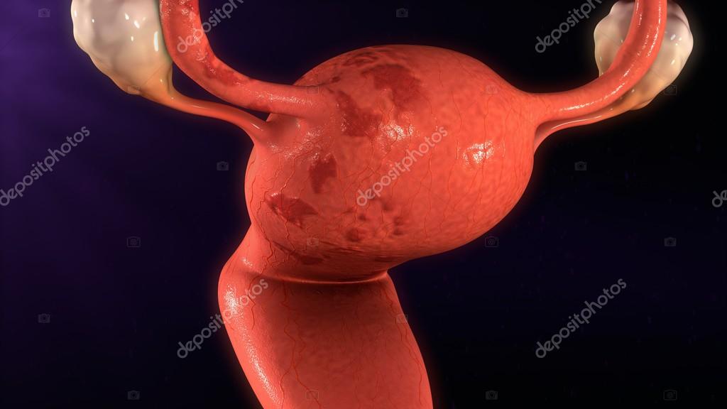 Uterus endometriosis disease — Stock Photo © sciencepics #112256420