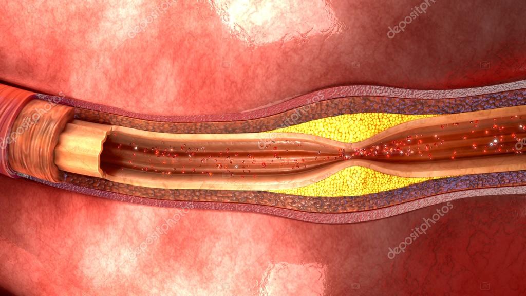 Human Artery Atherosclerosis Stock Photo by ©sciencepics 123332984