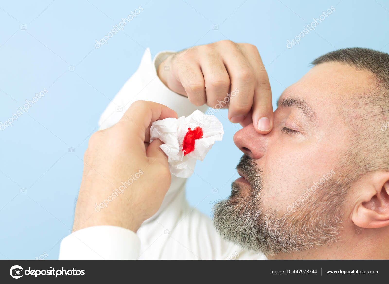 Man Suffering Nosebleed Epistaxis Using Paper Tissue Stop Bleeding ...