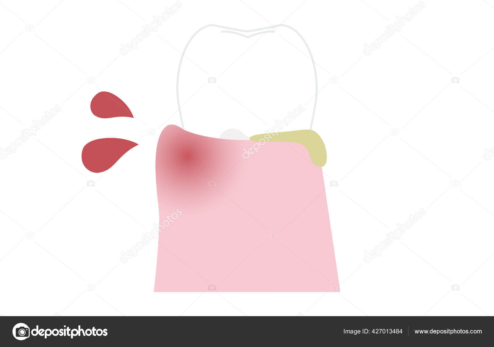 Illustration Stage Periodontal Disease Moderate Periodontitis Stock ...