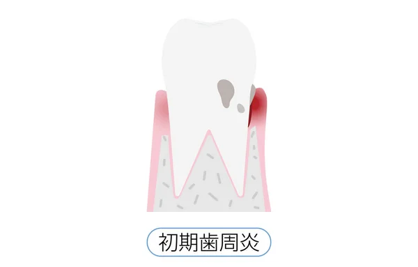 Periodontal Disease Progression Illustration Stage Stock Vector By ©t K
