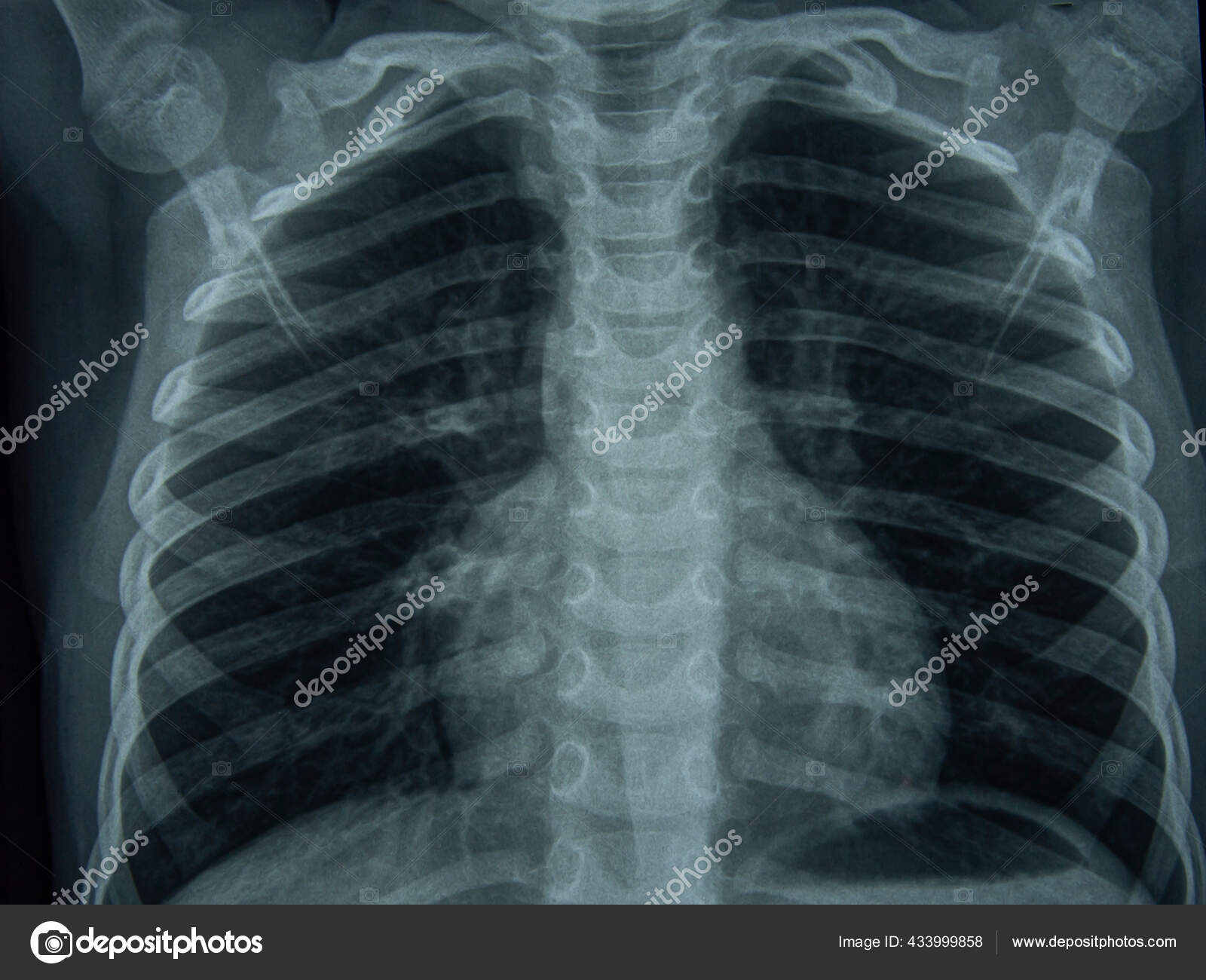 Citra radiografis atau Gambar X-Ray dada manusia untuk diagnosis medis ...