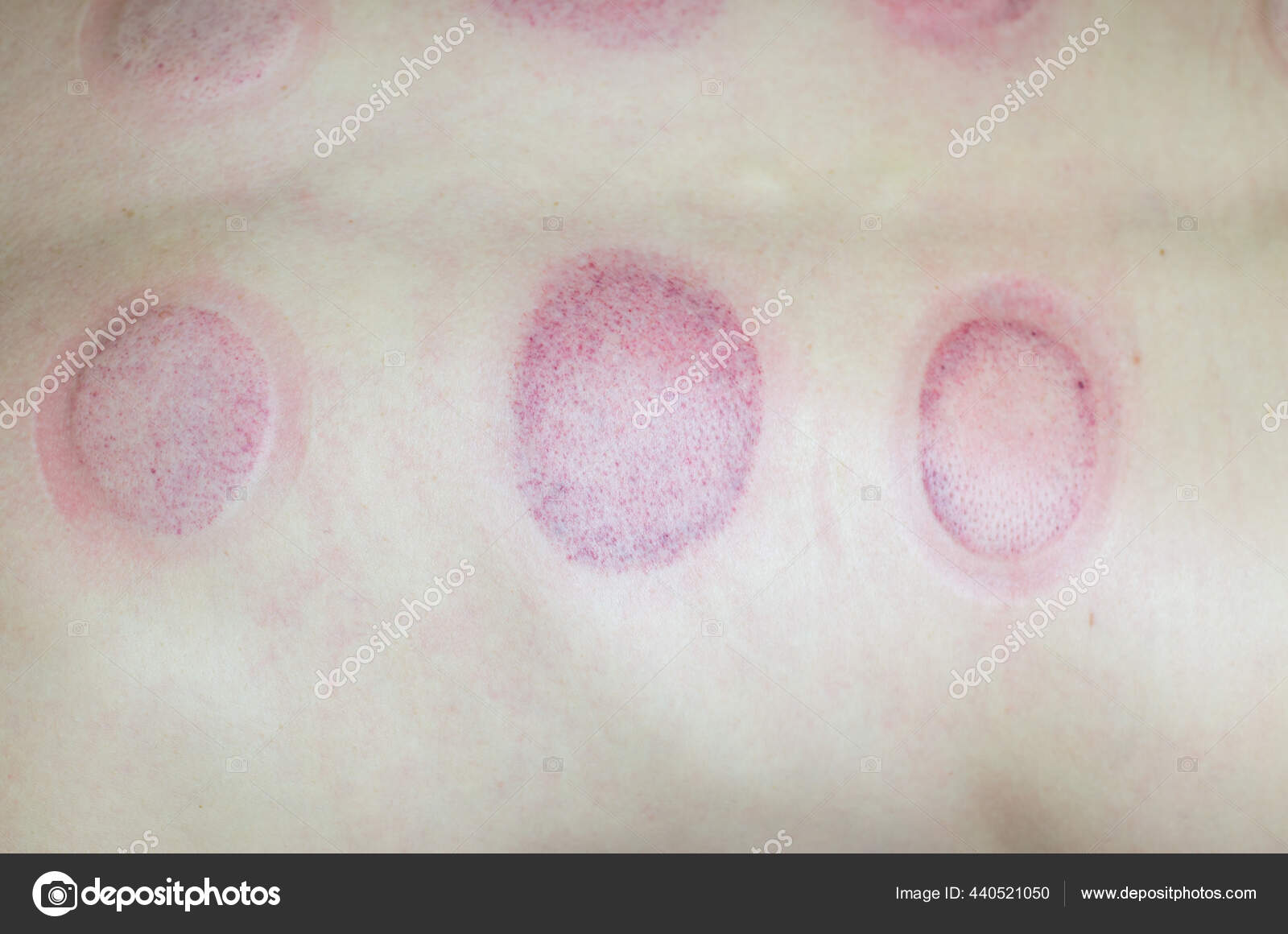 Moretones Espalda Después Ventosa Una Espalda Después Acupresión Cerca ...