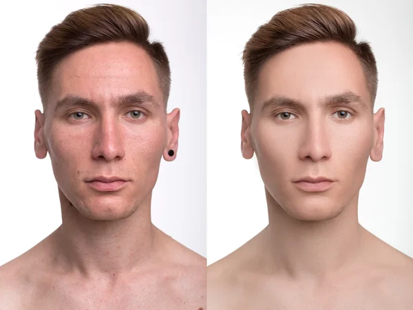 Botox before after Stock Photos, Royalty Free Botox before after Images ...