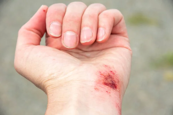 Bloody wound on the palm, arm, wrist after an accident or fall. Sport ...