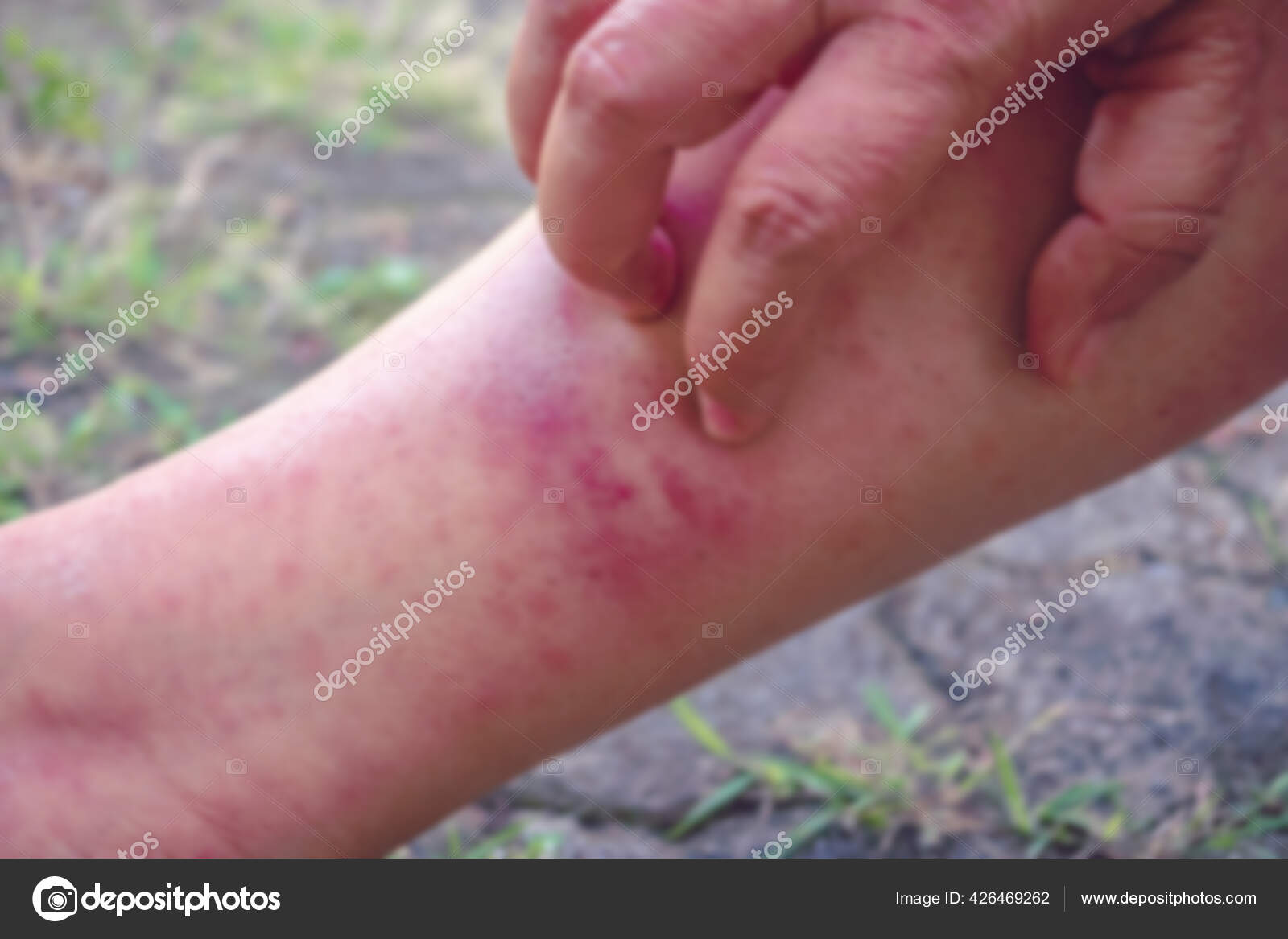 Dimsyn Vid Kliande Händer Dermatit Viral Dermatit Kliande Dermatit ...