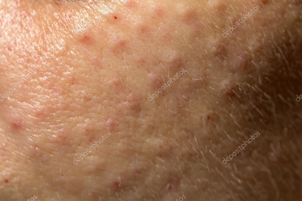 Problematic human skin with pimples Stock Photo by ©Tverdohlib.com ...