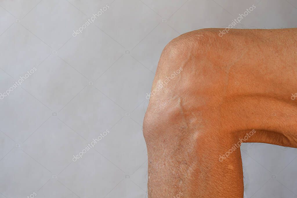 Un bulto en la pierna debajo de la articulación de la rodilla. 2024