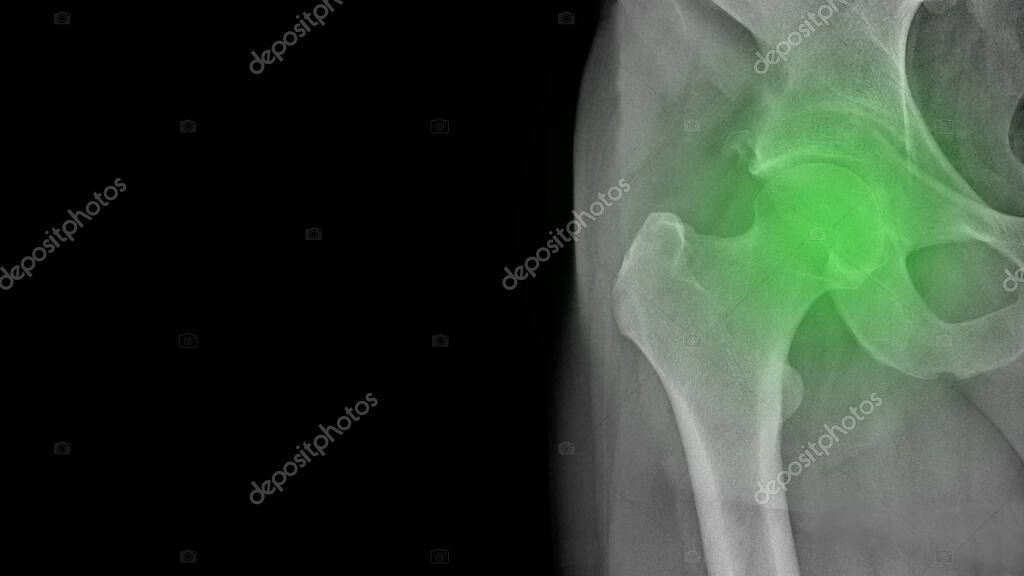 La radiograf a de una cadera sana en la articulaci n de la cadera izquierda de un hombre en el ...