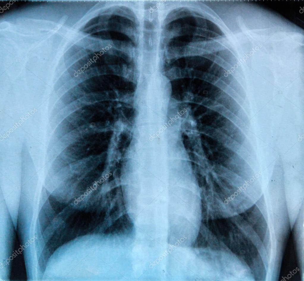 Chest X-ray Image Stock Photo by ©Photoprofi30@ 55158859