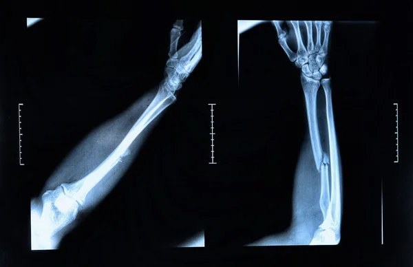 X Rays Of Broken Arm