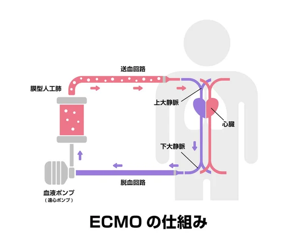 Ecmo Extracorporeal Membrane Oxygenation Structure Vector Illustration ...
