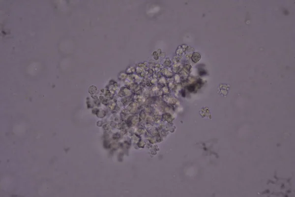 Cáncer de leucocitos Stock Photos, Royalty Free Cáncer de leucocitos ...