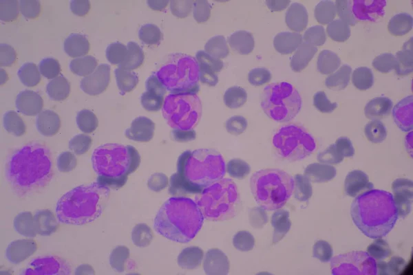 Lymphocytes atypiques Stock Photos, Royalty Free Lymphocytes atypiques ...