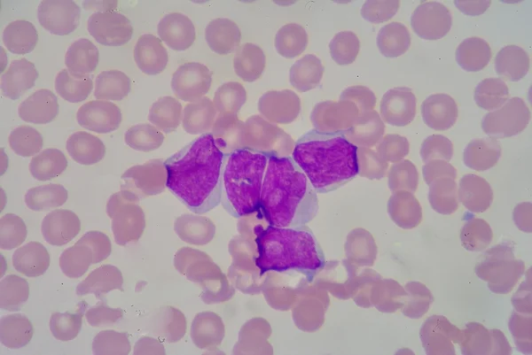 Lymphocytes atypiques Stock Photos, Royalty Free Lymphocytes atypiques ...