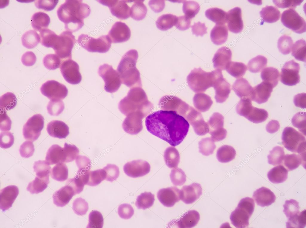 Basket Cell Blood Smear