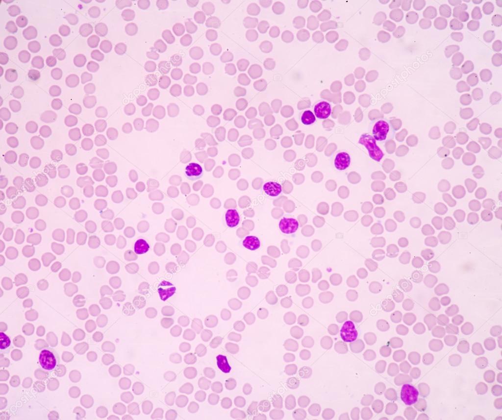 Chronic lymphocytic Leukemia(CLL) — Stock Photo © toeytoey #78250250