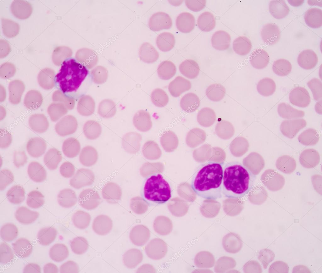 Chronic lymphocytic Leukemia(CLL) Stock Photo by ©toeytoey 78250252