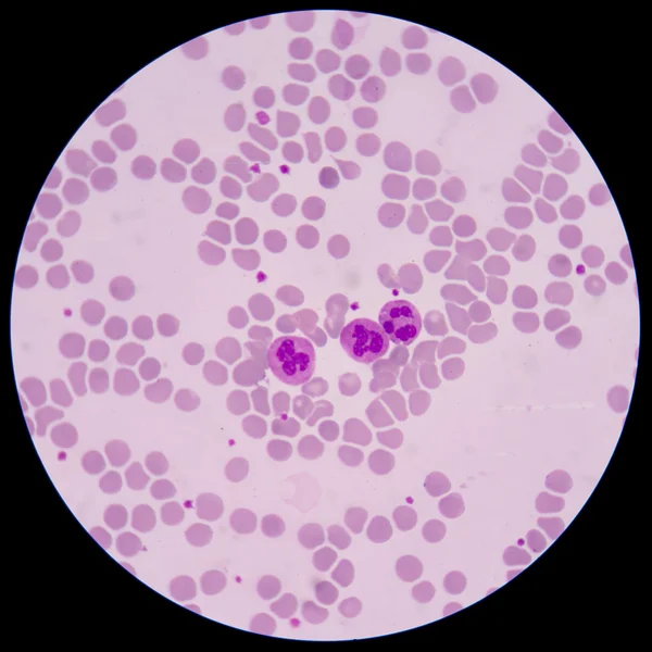 Blood smear form sepsis.septicemia can progress to sepsis. — Stock ...