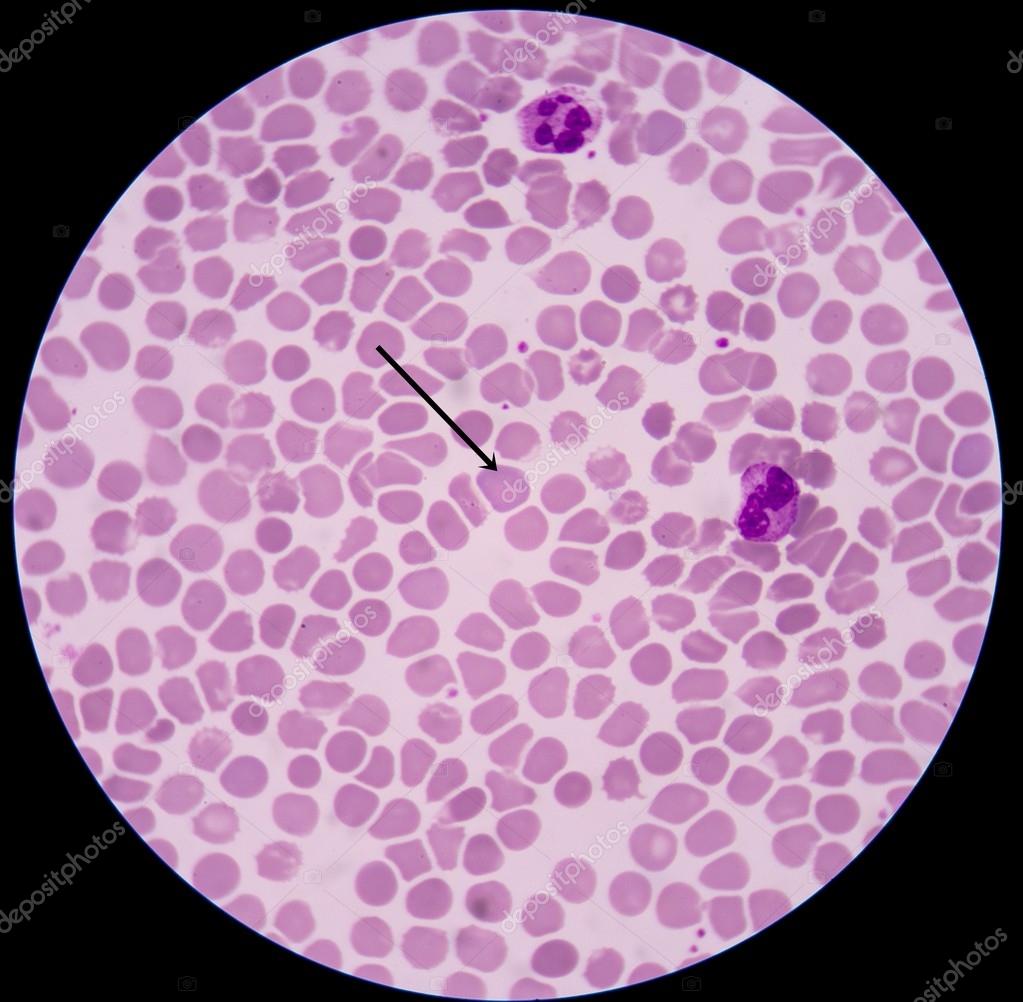 Polychromasia은 장애 적혈구의 비정상적으로 높은 숫자입니다 — 스톡 사진 © toeytoey #97018696
