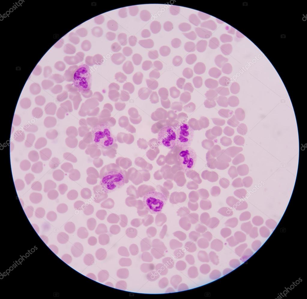 Blood smear form sepsis.septicemia can progress to sepsis. — Stock ...