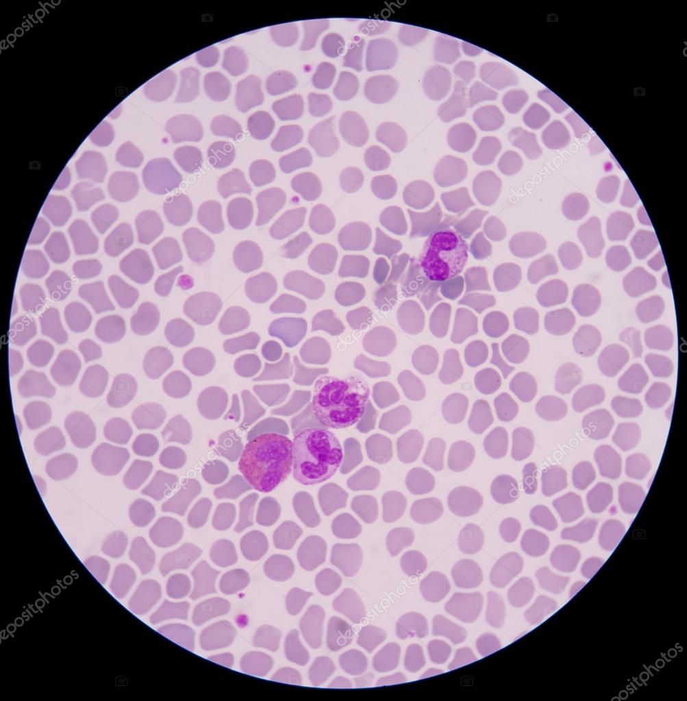 Blodutstryk i form av sepsis. sepsis kan utvikle seg til sepsis ...