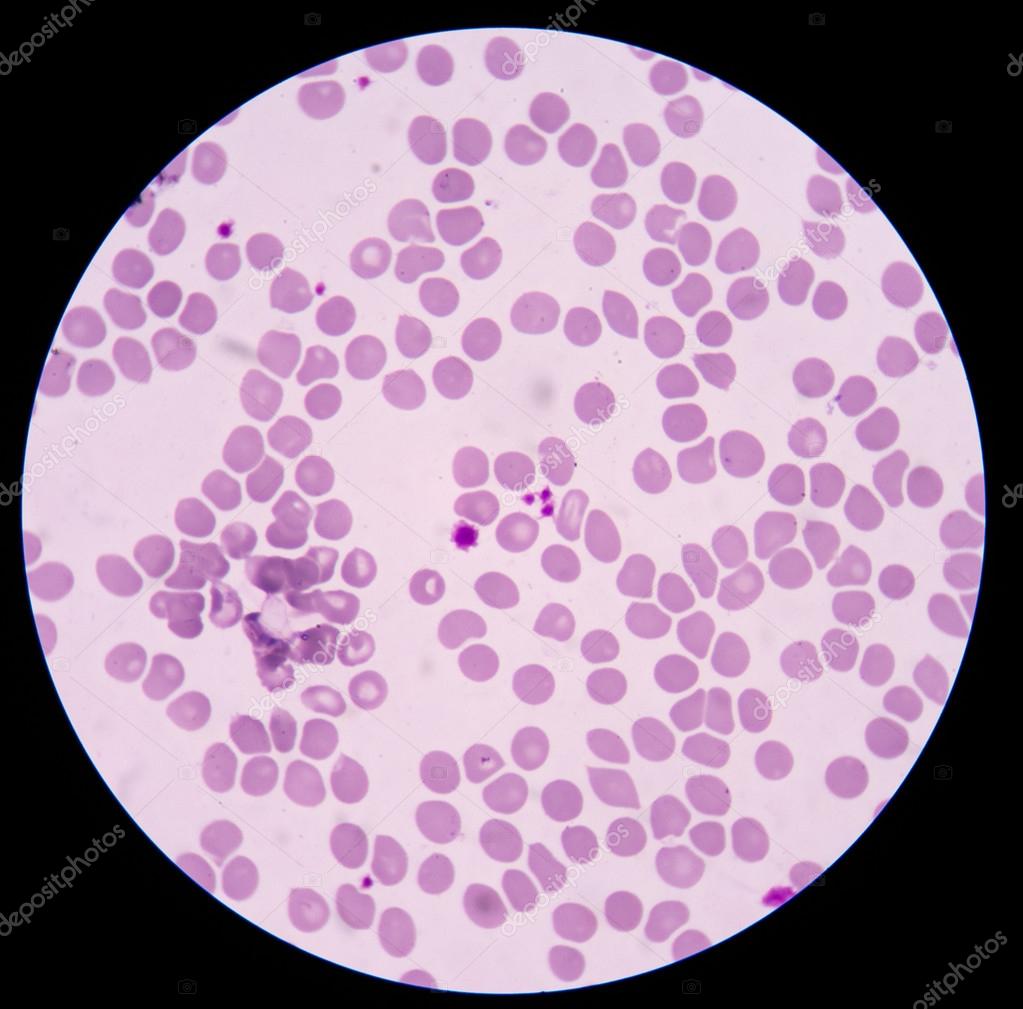 Imágenes: plaquetas gigantes | plaquetas gigantes en frotis de sangre ...