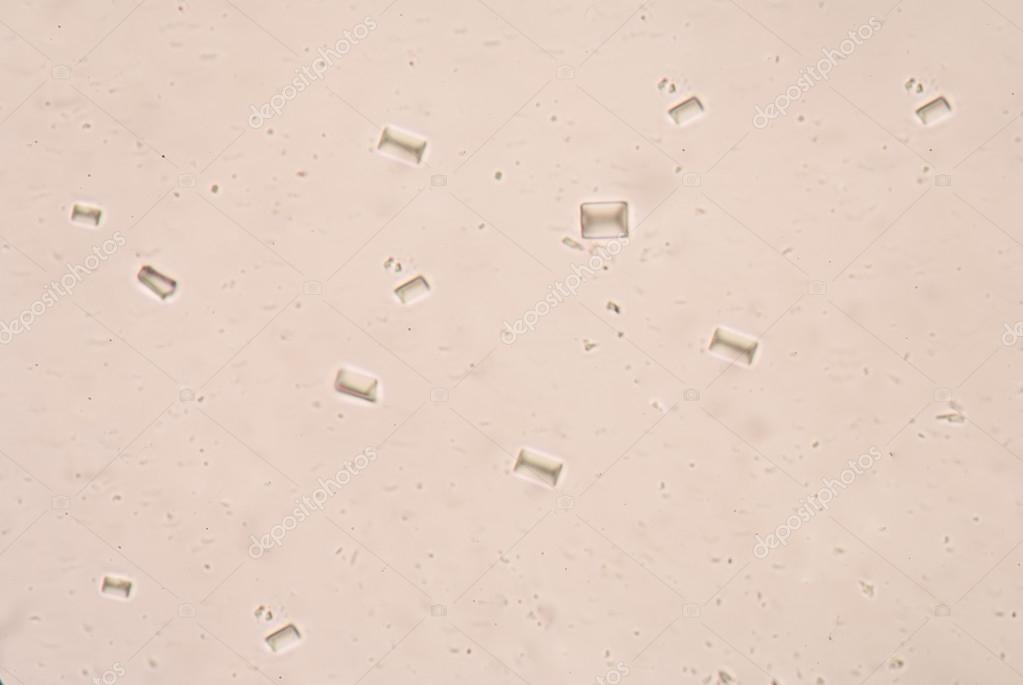 Triple fosfaat kristallen in menselijke urine — Stockfoto © toeytoey ...