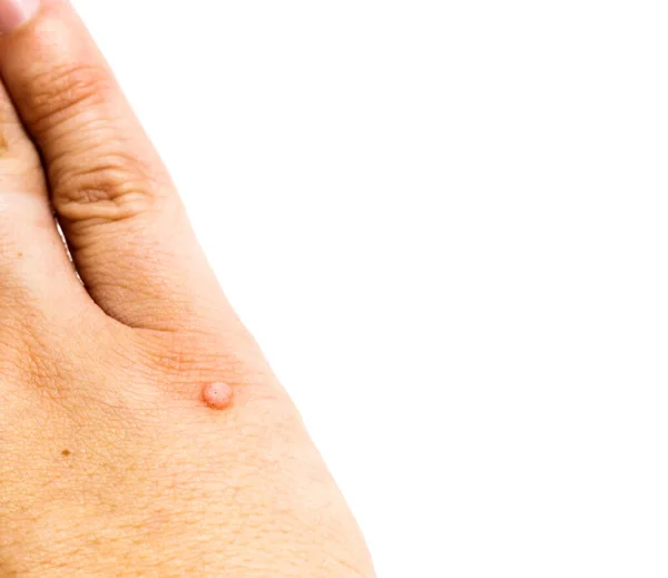 Salicylic acid Stockfoto's, Rechtenvrije Salicylic acid afbeeldingen ...