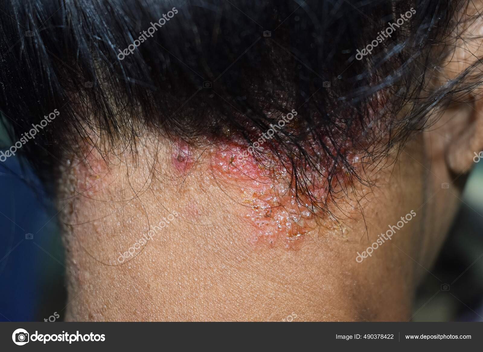 Candida Skin Back