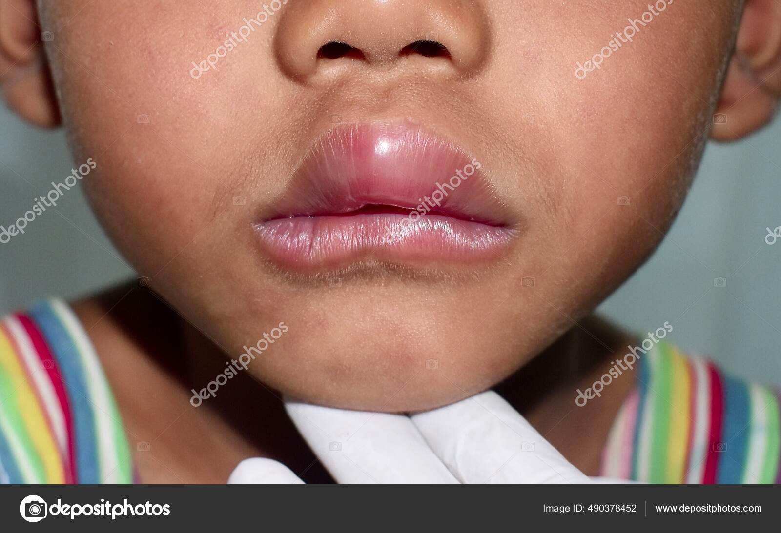 Angioedema Los Labios Del Niño Del Sudeste Asiático Niño Edematoso ...
