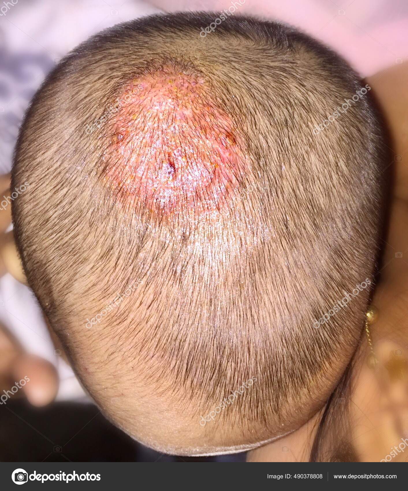 Tinea Capitis Traités Infection Fongique Sur Cuir Chevelu L'asie Sud ...