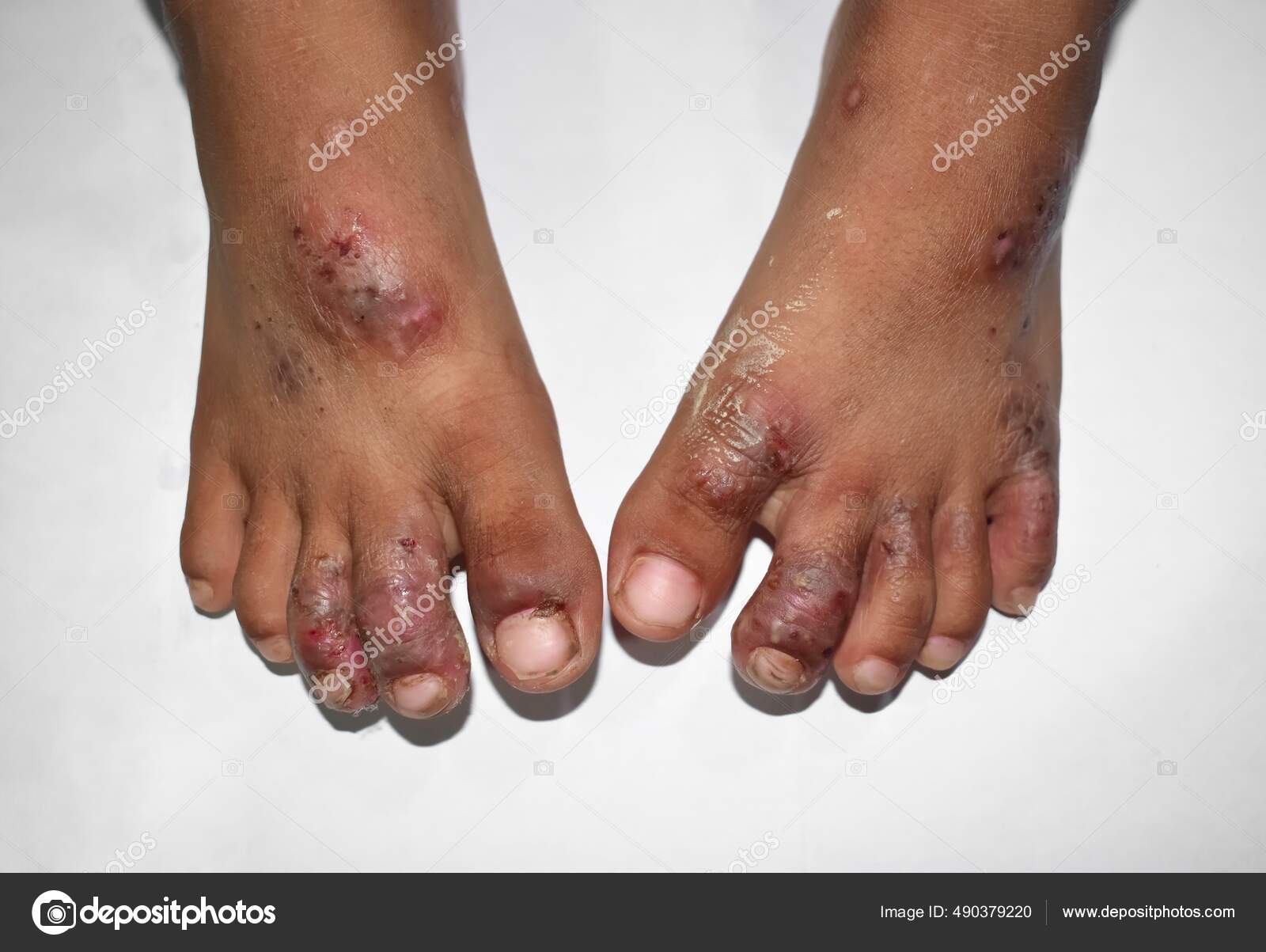 Infestación Por Sarna Con Infección Bacteriana Secundaria Superpuesta ...